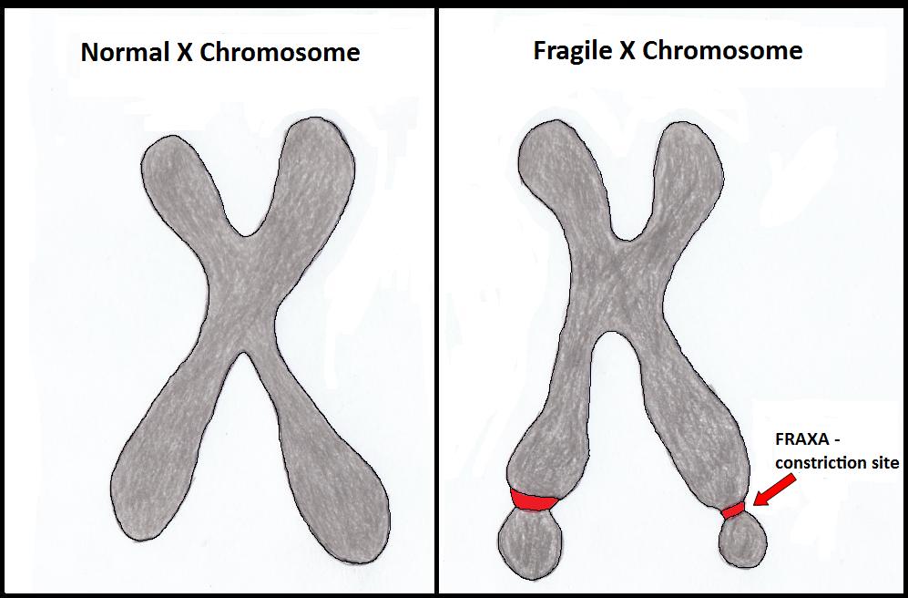 File Fragile X Chromosome jpg Embryology