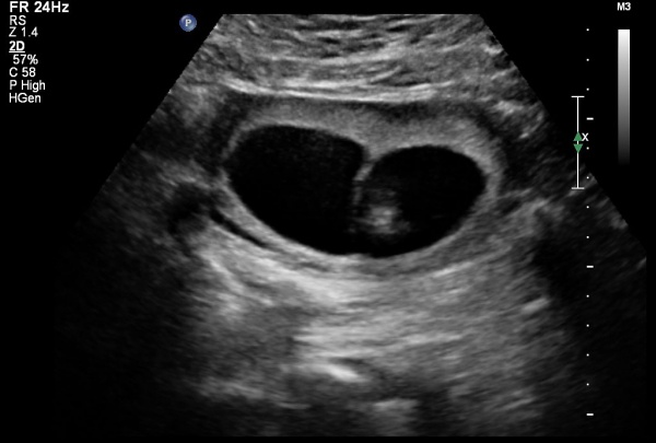 Abnormal Development - Twinning - Embryology