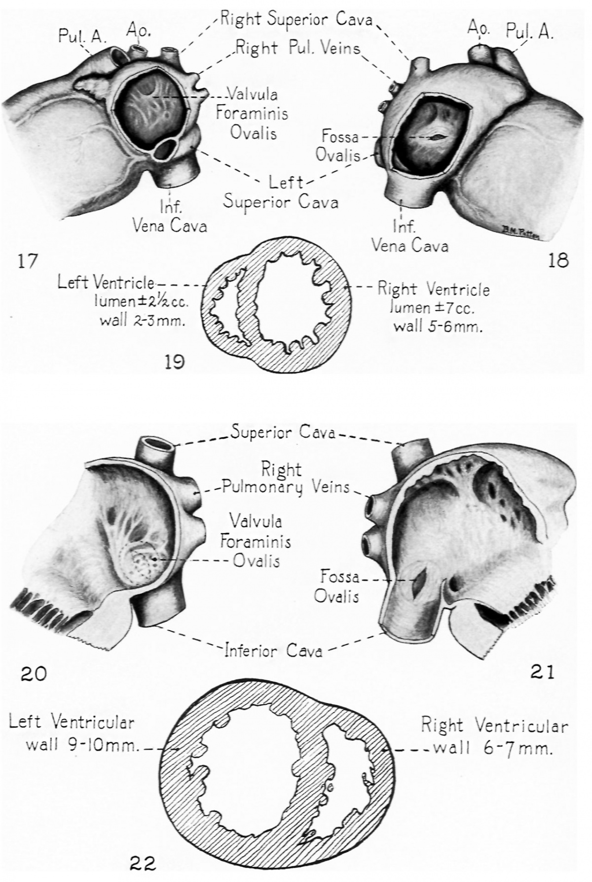 Paper - Developmental defects at the foramen ovale (1938) - Embryology