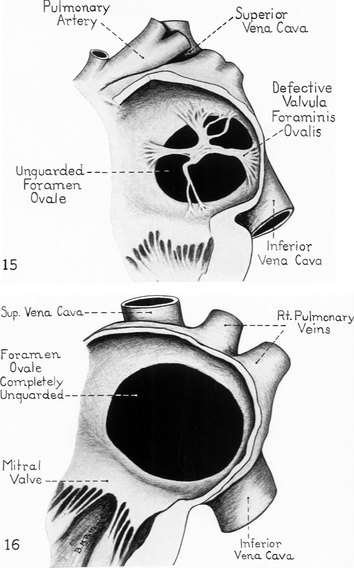 Paper - Developmental defects at the foramen ovale (1938) - Embryology
