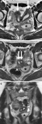 Vagina Development - Embryology