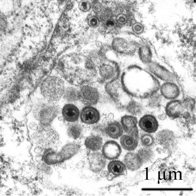 Abnormal Development - Cytomegalovirus - Embryology