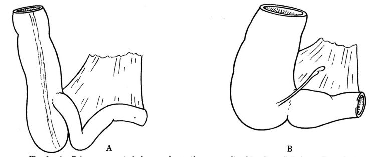 Paper - Appendix vermiformis duplex (1936) - Embryology