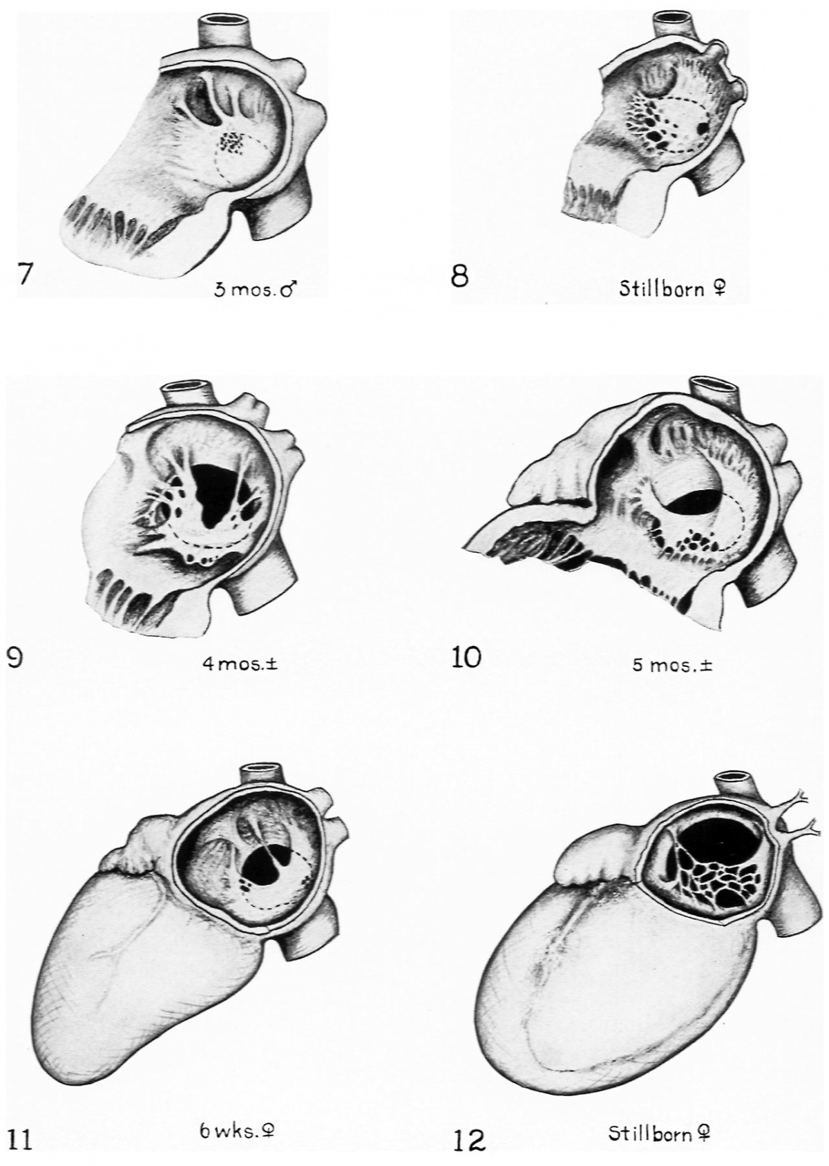 Paper - Developmental defects at the foramen ovale (1938) - Embryology