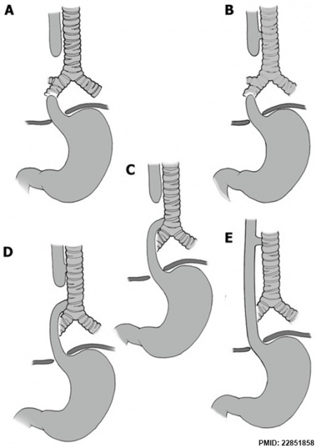 BGDB Gastrointestinal - Abnormalities - Embryology