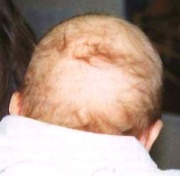 Integumentary System - Hair Development - Embryology