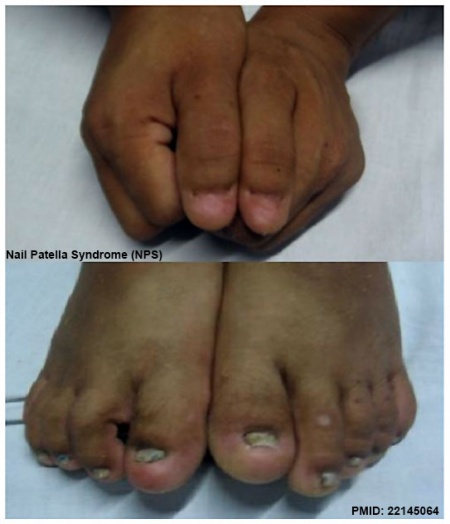 Integumentary System - Nail Development - Embryology