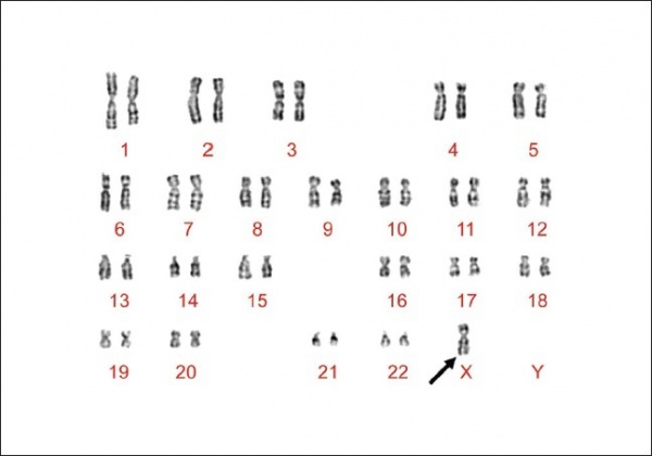 BGDB Sexual Differentiation - Abnormalities - Embryology