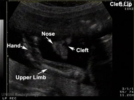 Abnormal Development - Cleft Palate - Embryology
