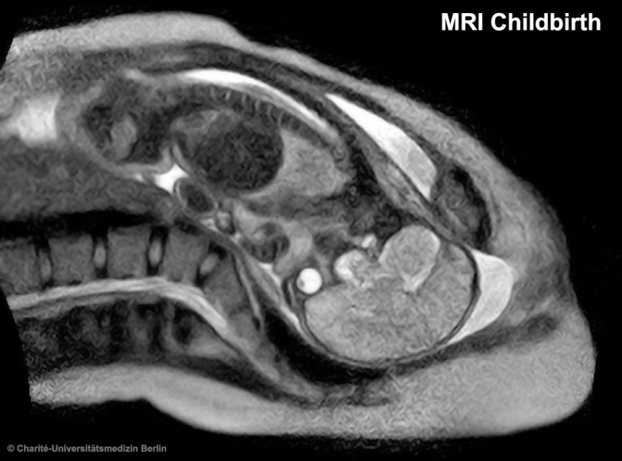 Magnetic Resonance Imaging - Embryology