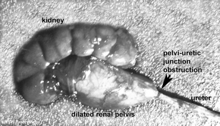 Renal System - Abnormalities - Embryology