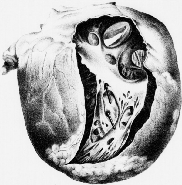 Cardiovascular System - Ventricular Septal Defects - Embryology