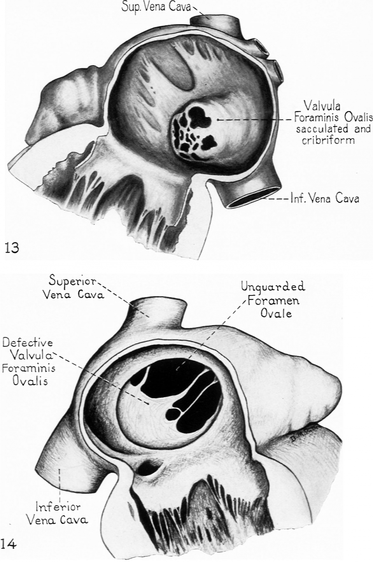 Paper - Developmental defects at the foramen ovale (1938) - Embryology