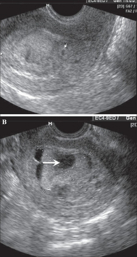 Abnormal Development - Hydatidiform Mole - Embryology