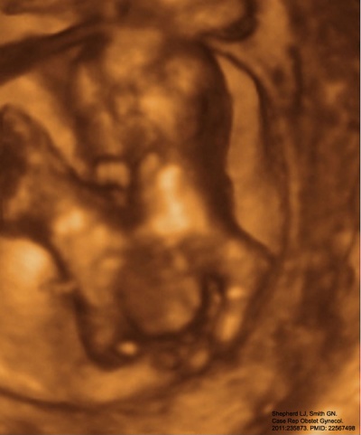 Abnormal Development - Twinning - Embryology