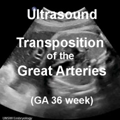 Template:Ultrasound Transposition Great Arteries - Embryology