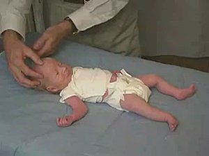 Neural Abnormal Exam - Newborn tone - scarf sign - Embryology