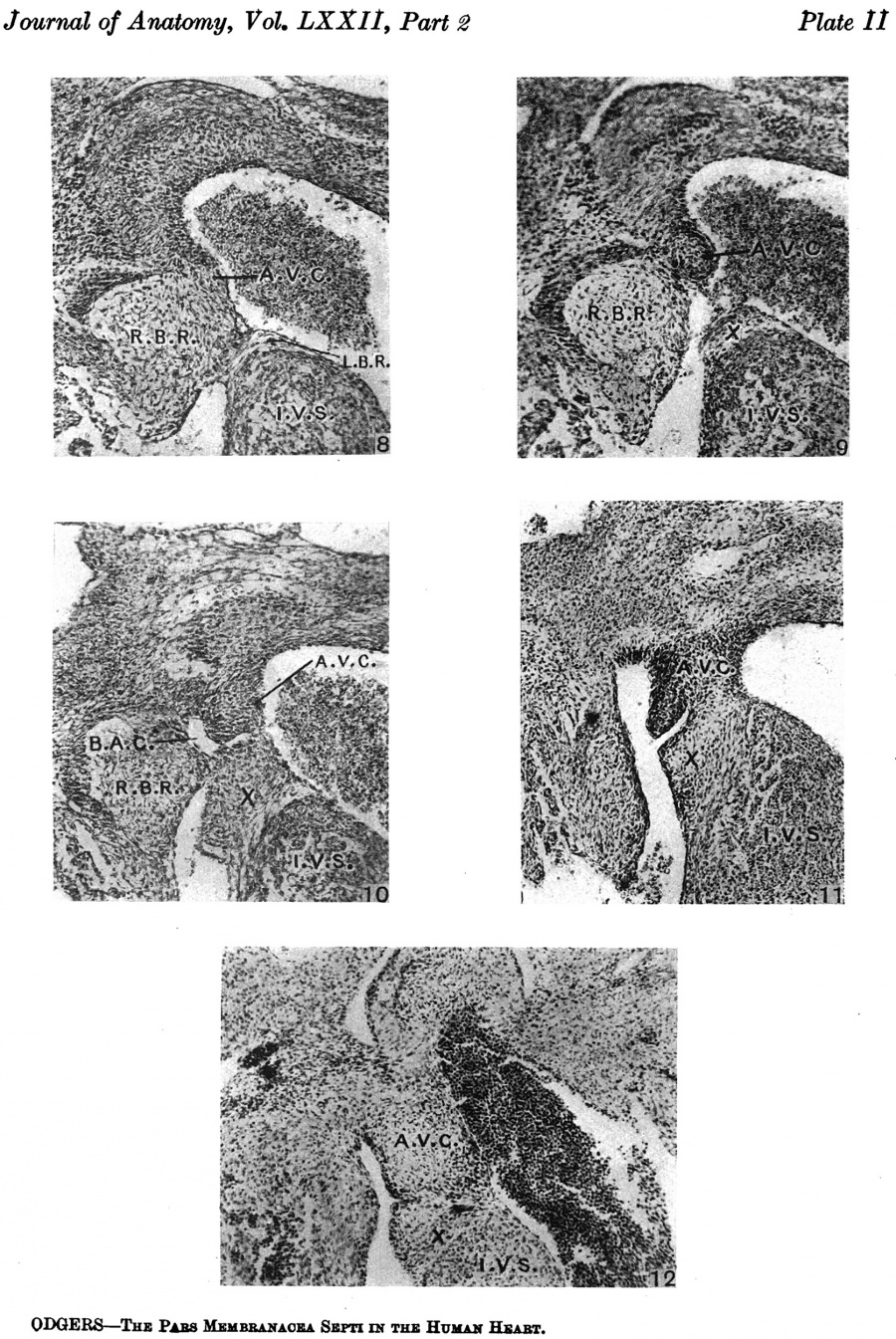 Paper - The Development of the Pars Membranacea Septi in the Human ...