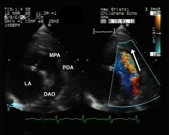 Cardiovascular System - Patent Ductus Arteriosus - Embryology