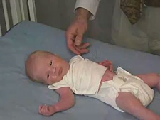 Neural Abnormal Exam - Newborn reflexes - Moro - Embryology