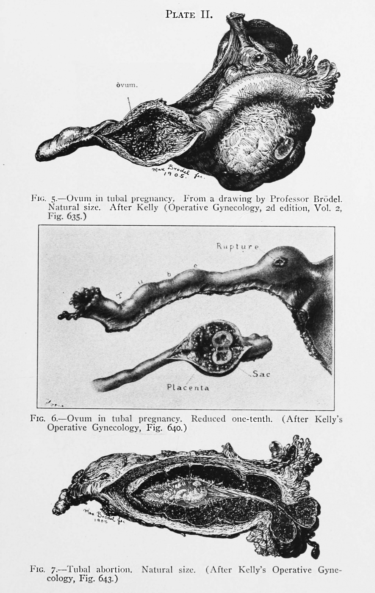 Paper - A study of the causes underlying the origin of human monsters ...