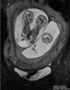 Category:Twinning - Embryology
