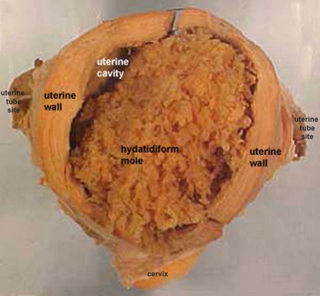 Abnormal Development - Hydatidiform Mole - Embryology