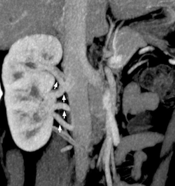 Renal System - Abnormalities - Embryology