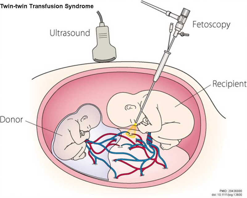 Abnormal Development - Twinning - Embryology