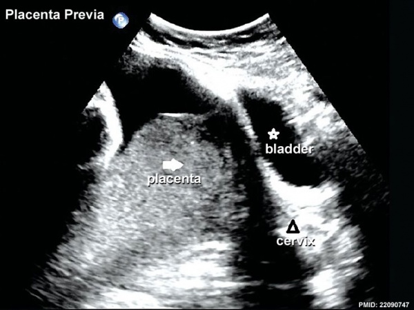 Placenta - Abnormalities - Embryology
