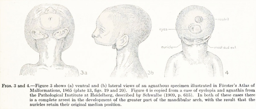 Head Development - Abnormalities - Embryology