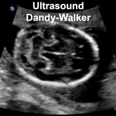 Template:Ultrasound Dandy-Walker - Embryology