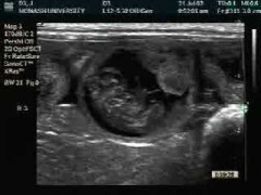 Ultrasound - Embryology